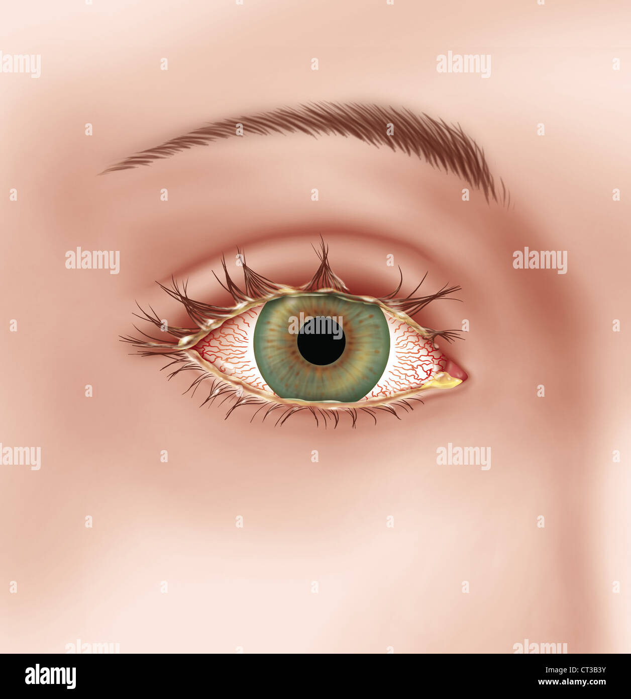 Conjonctivite virale Banque de photographies et d’images à haute ...