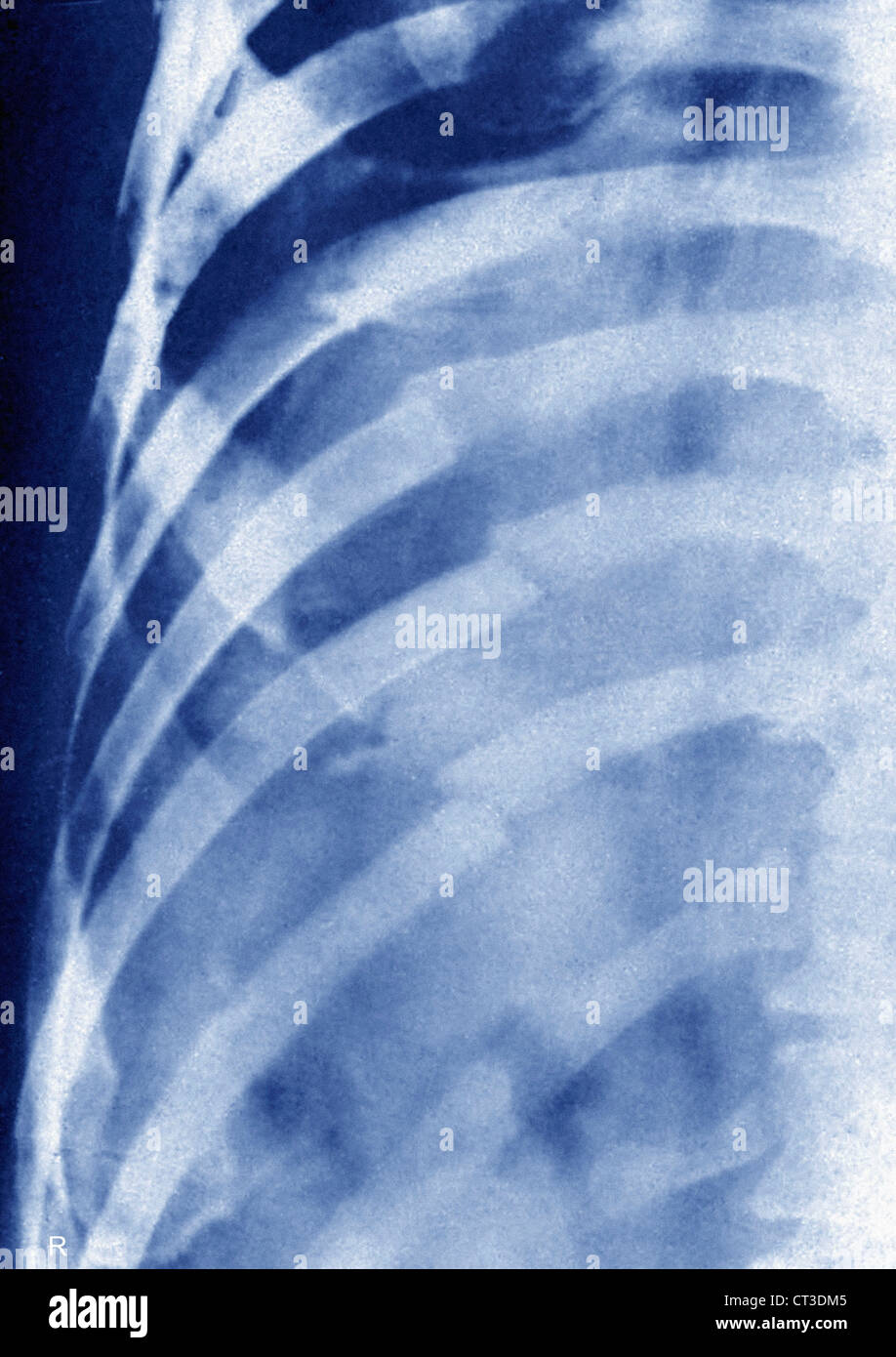 Fracture costale, X-RAY Photo Stock - Alamy