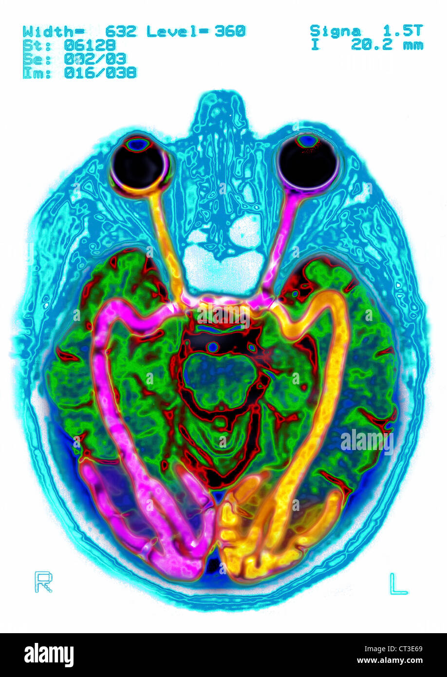 Irm normal du cerveau Banque de photographies et d’images à haute ...