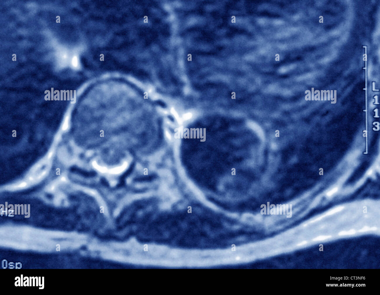 La Dissection aortique, l'IRM Photo Stock - Alamy