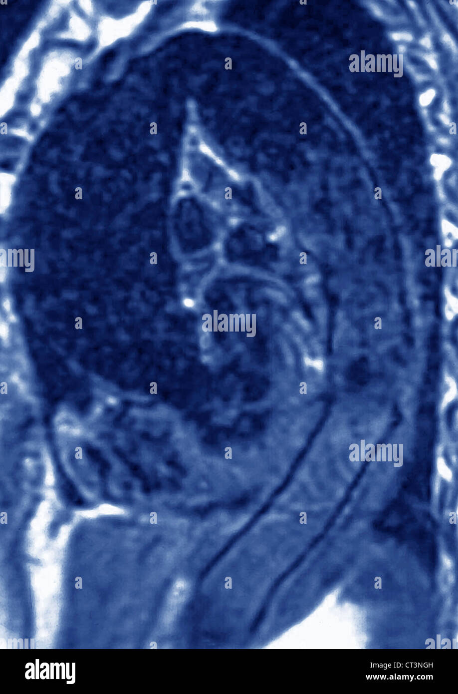 La Dissection aortique, l'IRM Photo Stock - Alamy