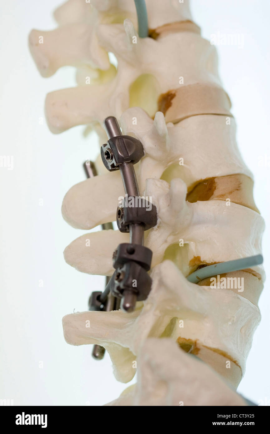 Fixation Interne Avec Broche Banque d'image et photos - Alamy