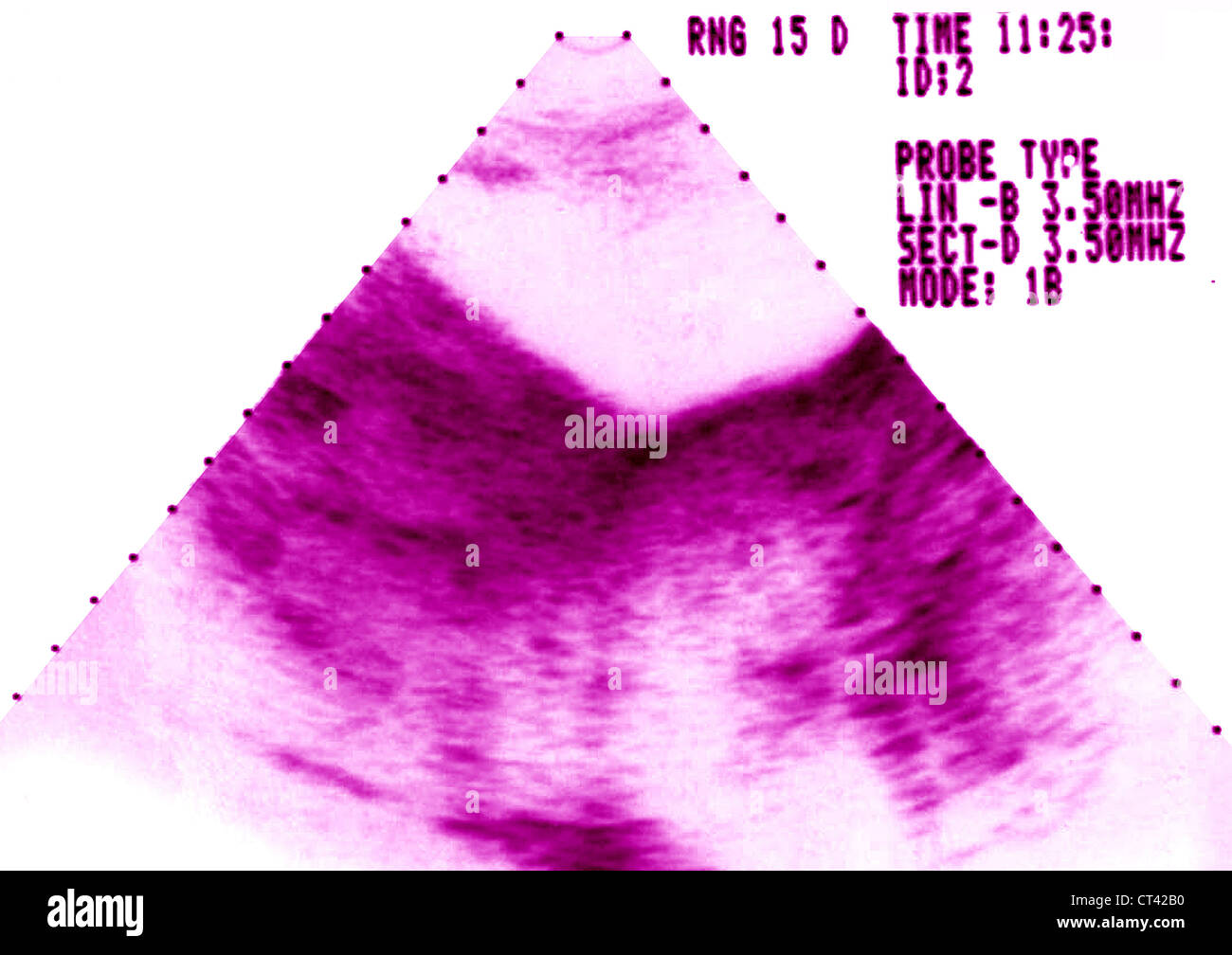 Utérus rétroverti Banque de photographies et d’images à haute ...