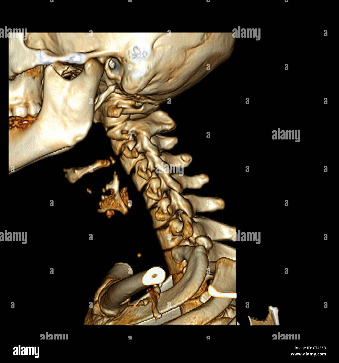 Cervical 3d scan Banque de photographies et d’images à haute résolution ...