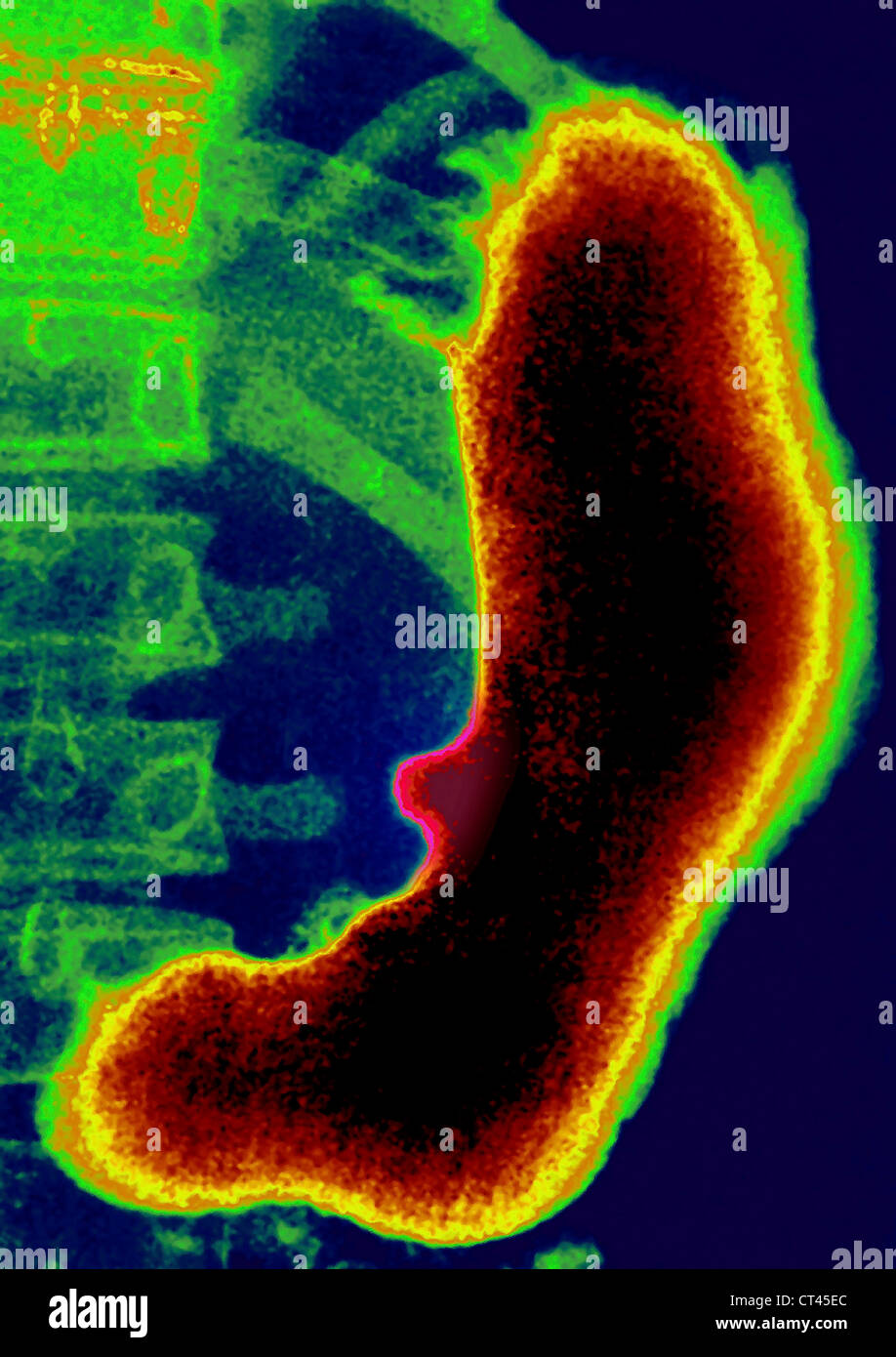 Ulcère gastrique, X-RAY Photo Stock - Alamy