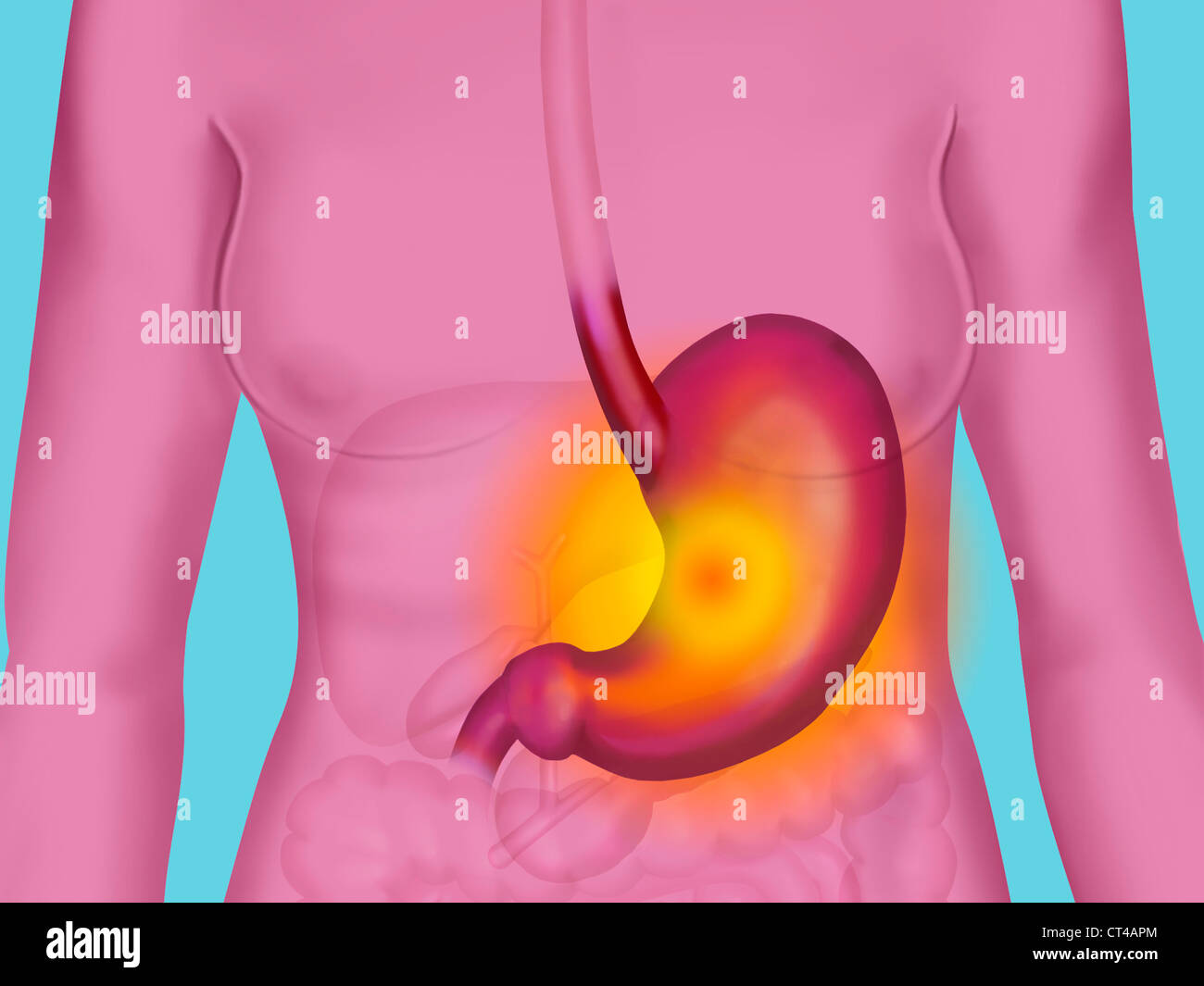 Ulcère gastrique, dessin Photo Stock - Alamy