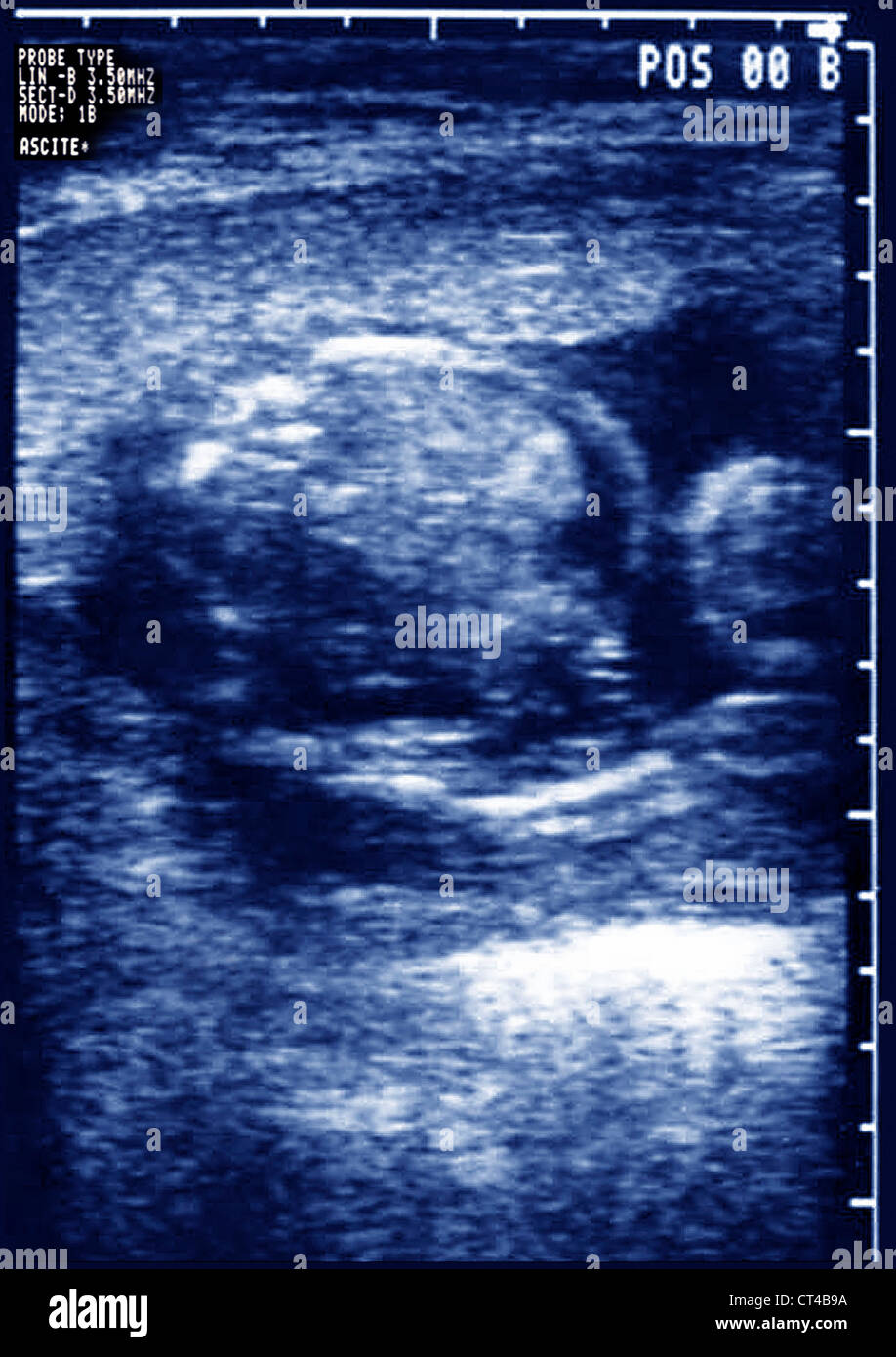 L'ascite FŒTUS, l'échographie Photo Stock - Alamy