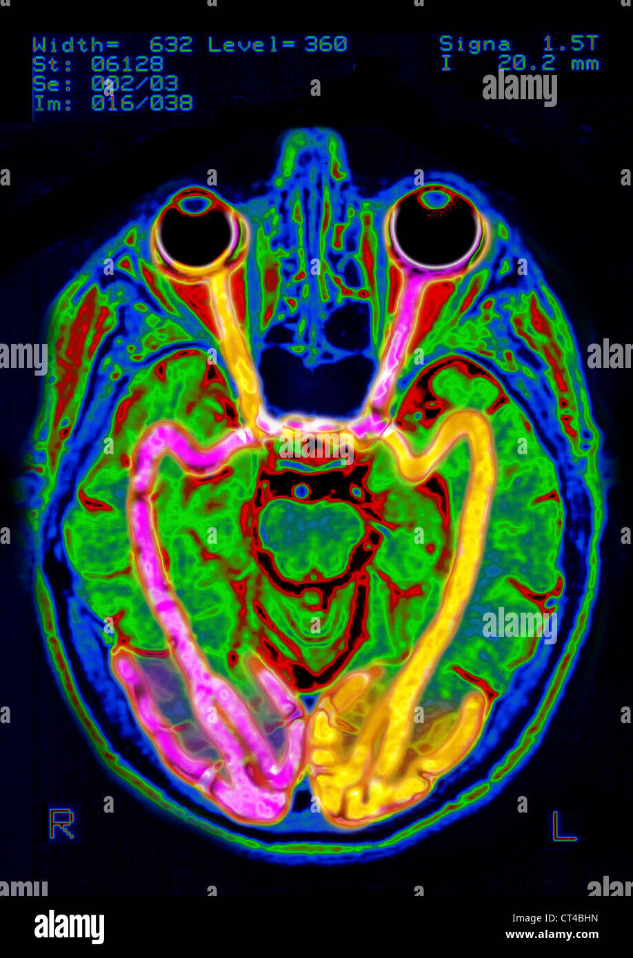 Mri Normal Brain Banque d'image et photos - Alamy