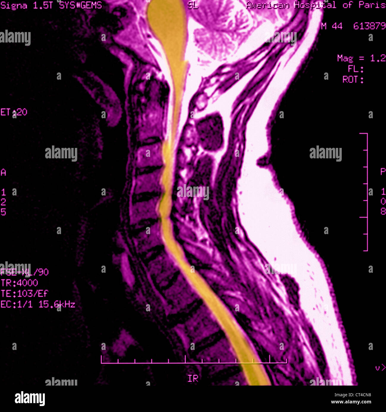 Arthrose Cervicale Banque d'image et photos - Alamy