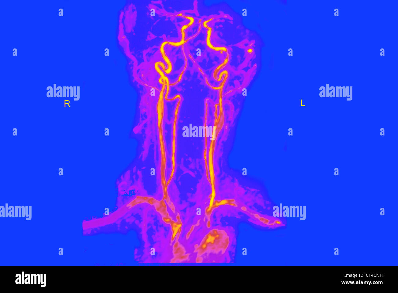Angiographie Carotidienne Interne Banque d'image et photos - Alamy