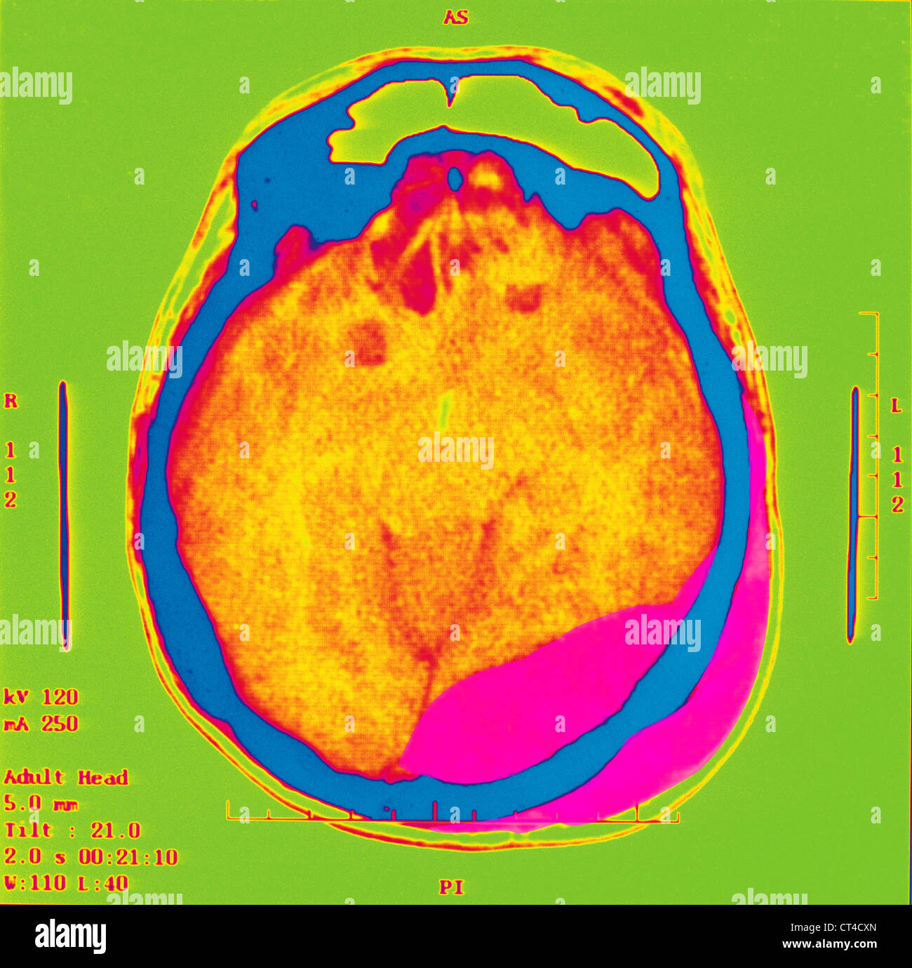 Vascularisation Cerebral Banque De Photographies Et Dimages à Haute