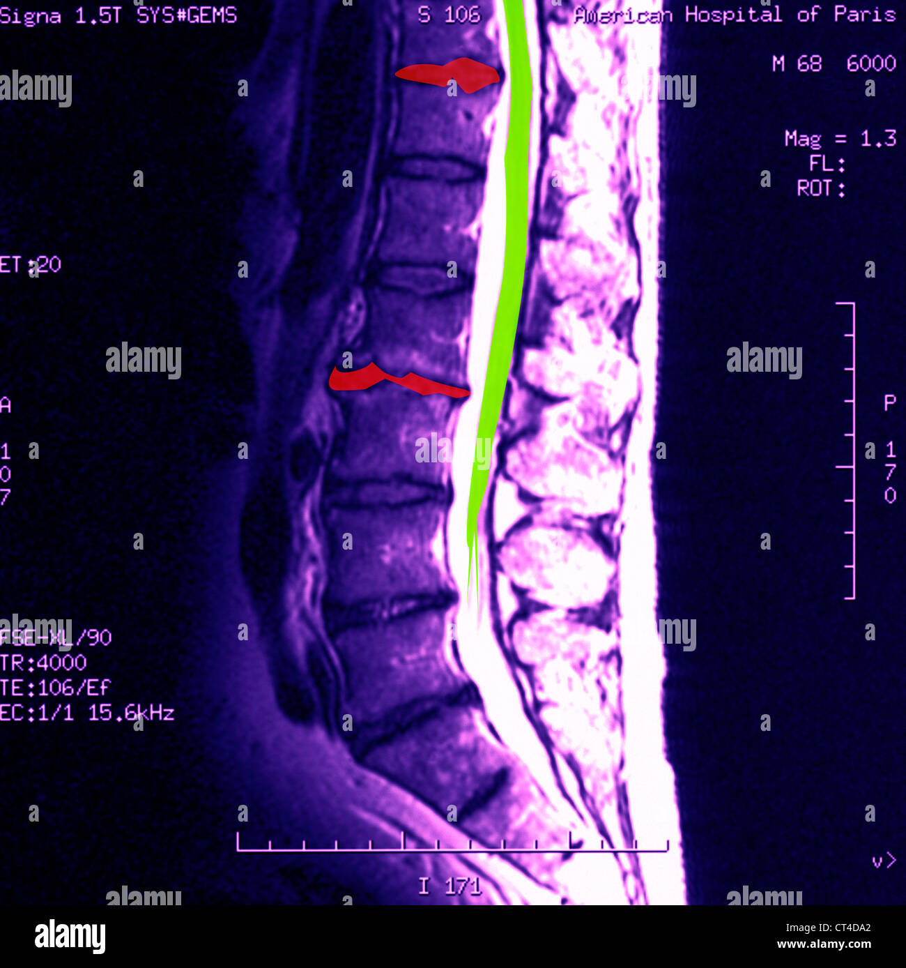 L'Arthrose vertébrale, IRM Photo Stock - Alamy