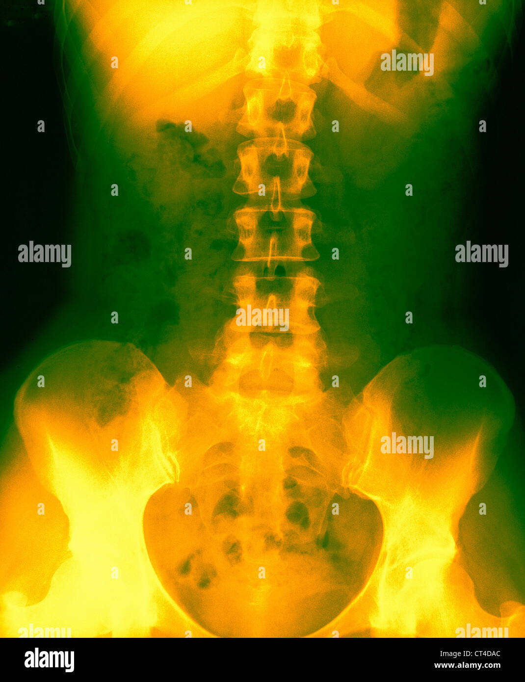 Colonne vertébrale, X-RAY Photo Stock - Alamy
