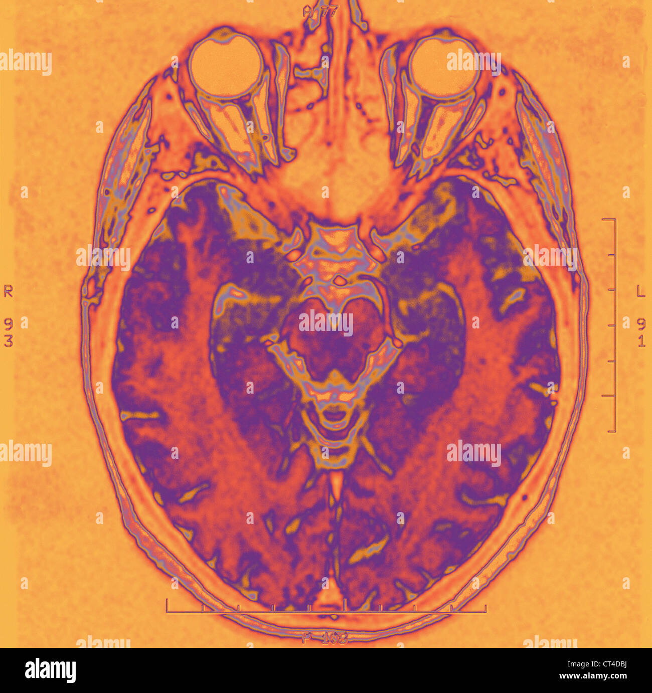 Irm normal du cerveau Banque de photographies et d’images à haute ...