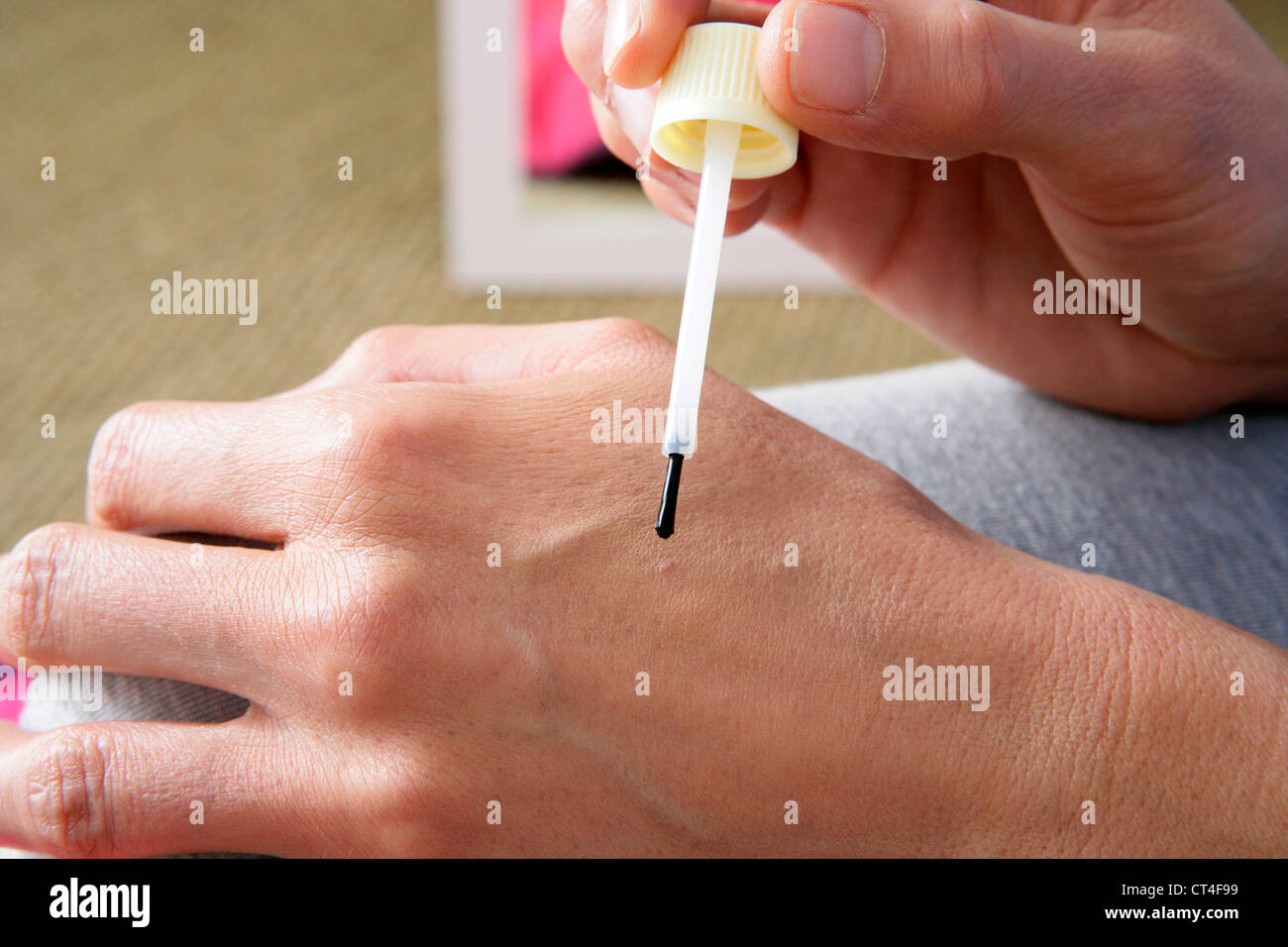 Verrues Cutanées Banque d'image et photos - Alamy