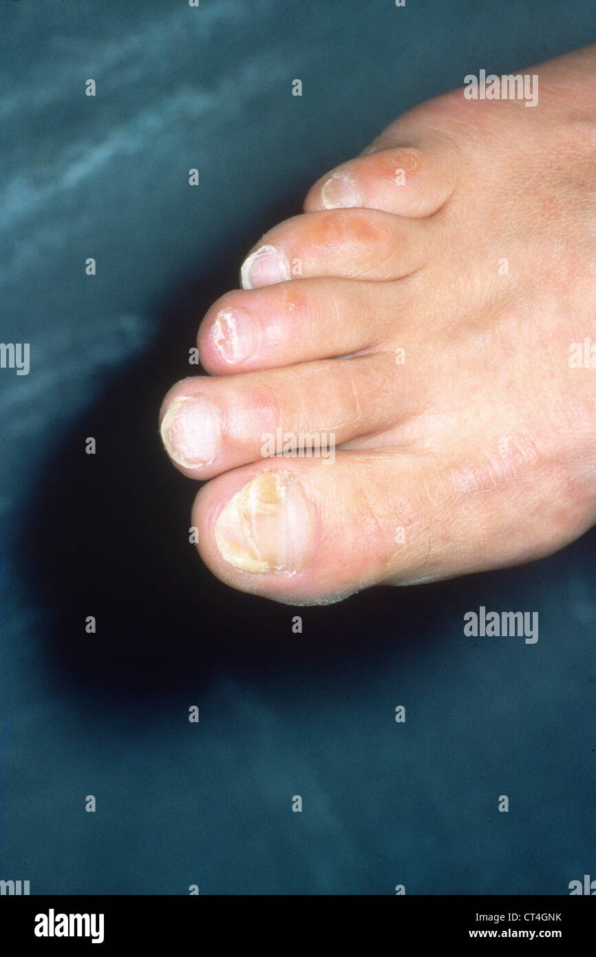 Pieds infectés mycose Banque de photographies et d’images à haute ...