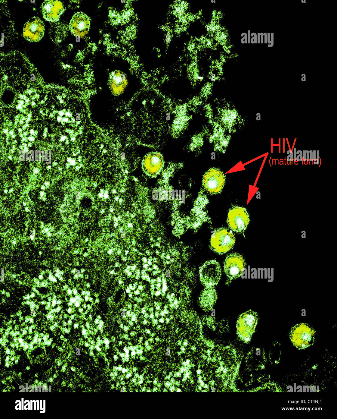 L'INFECTION PAR LE VIRUS DU SIDA, le TEM Photo Stock - Alamy