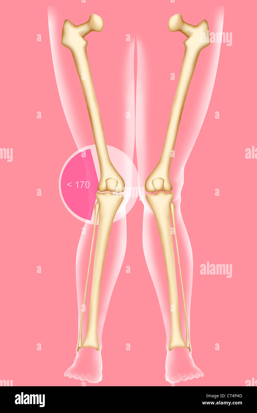 Genu valgum Banque de photographies et d’images à haute résolution - Alamy