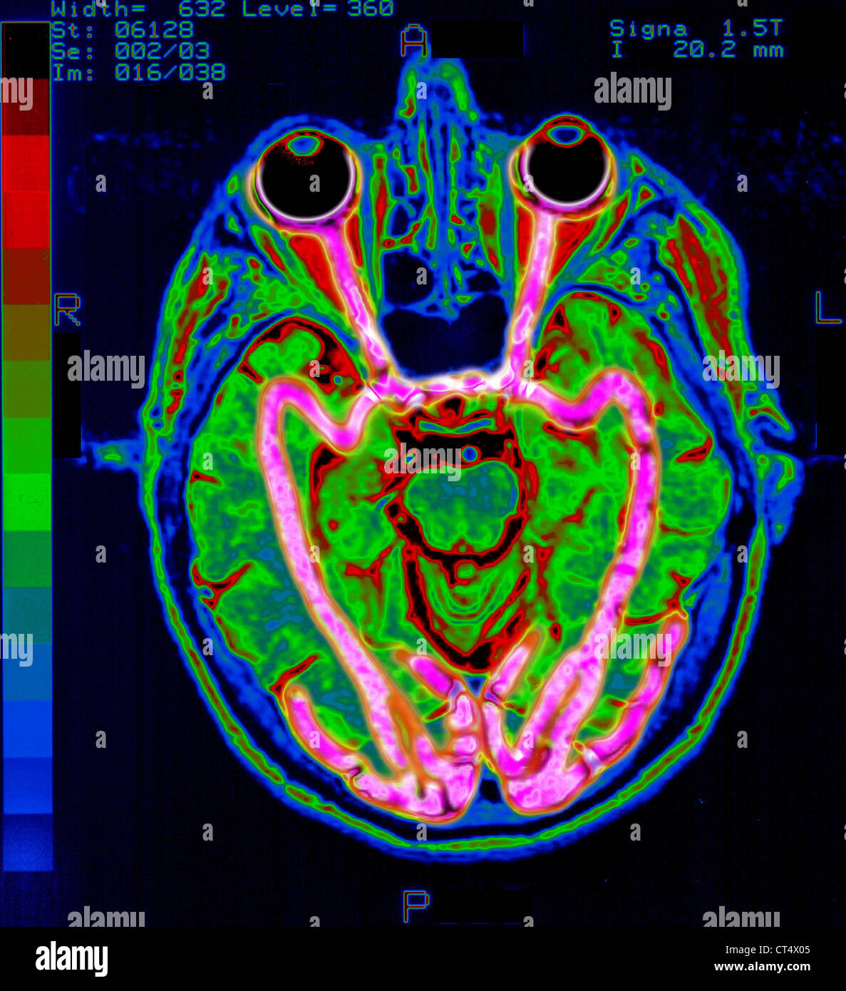 Irm normal du cerveau Banque de photographies et d’images à haute ...