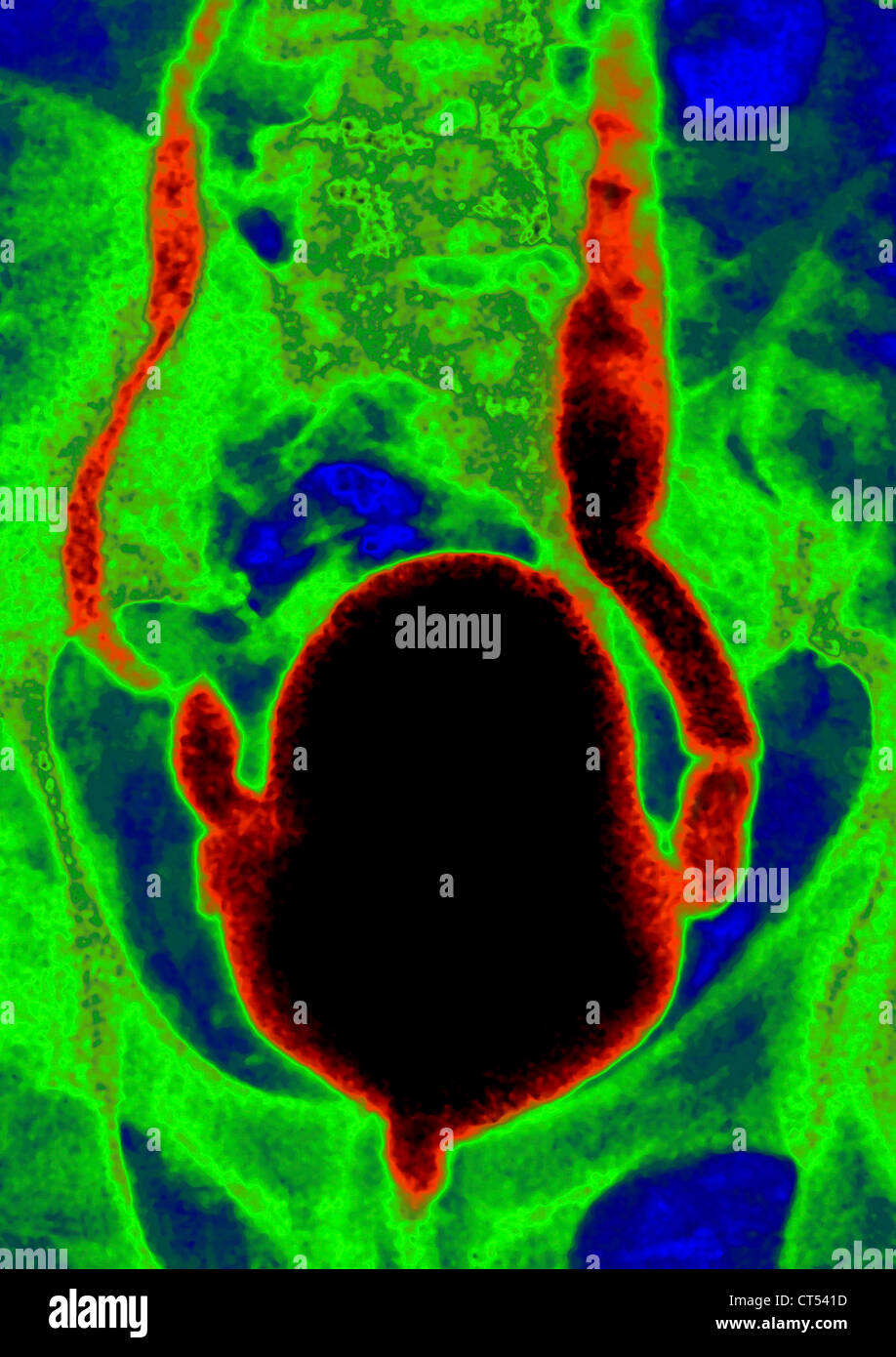 Urographie intraveineuse Banque de photographies et d’images à haute ...