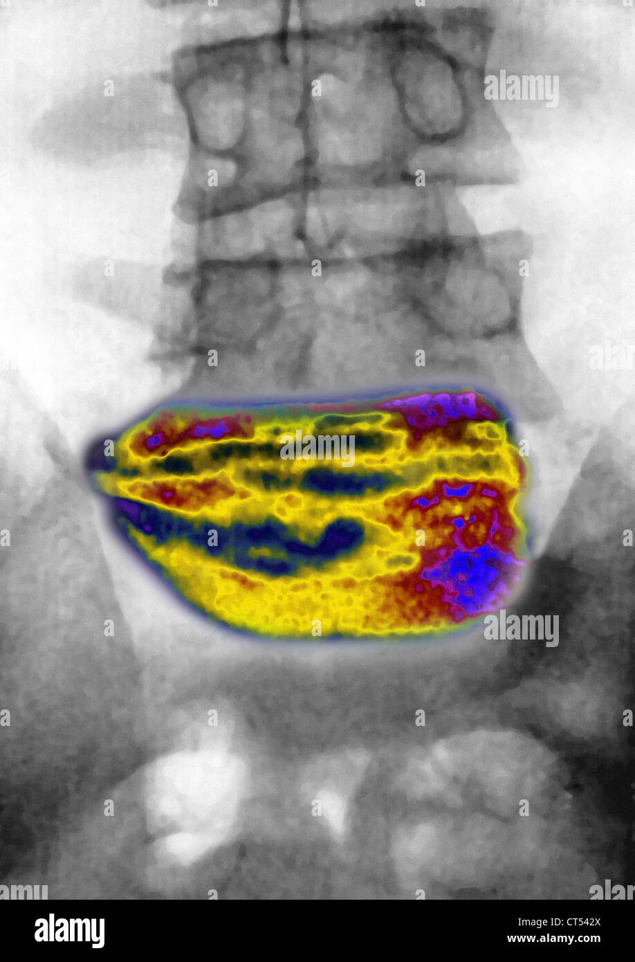 Le syndrome de la queue de cheval Photo Stock - Alamy