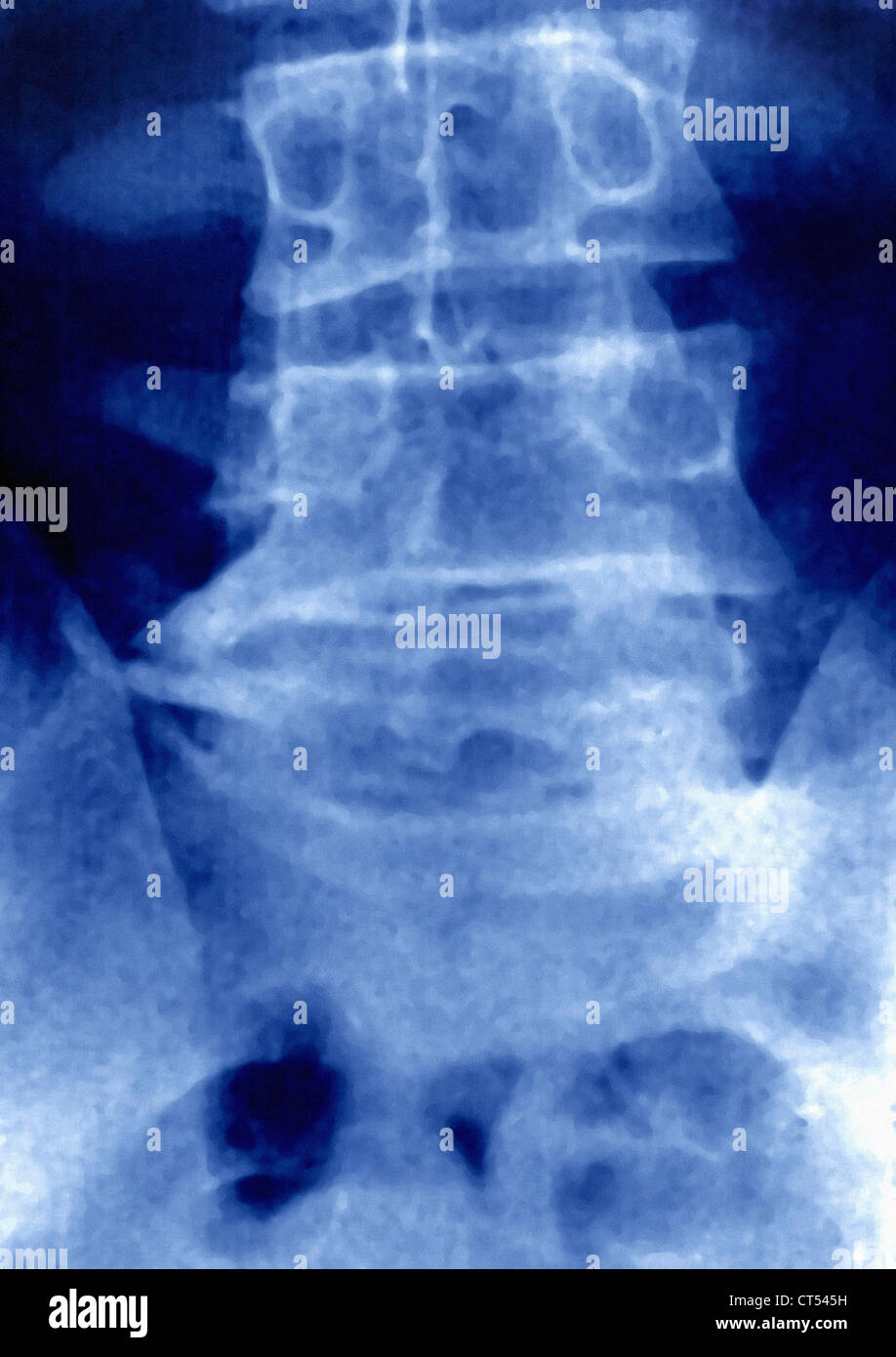 Syndrome de la queue de cheval Banque de photographies et d’images à ...