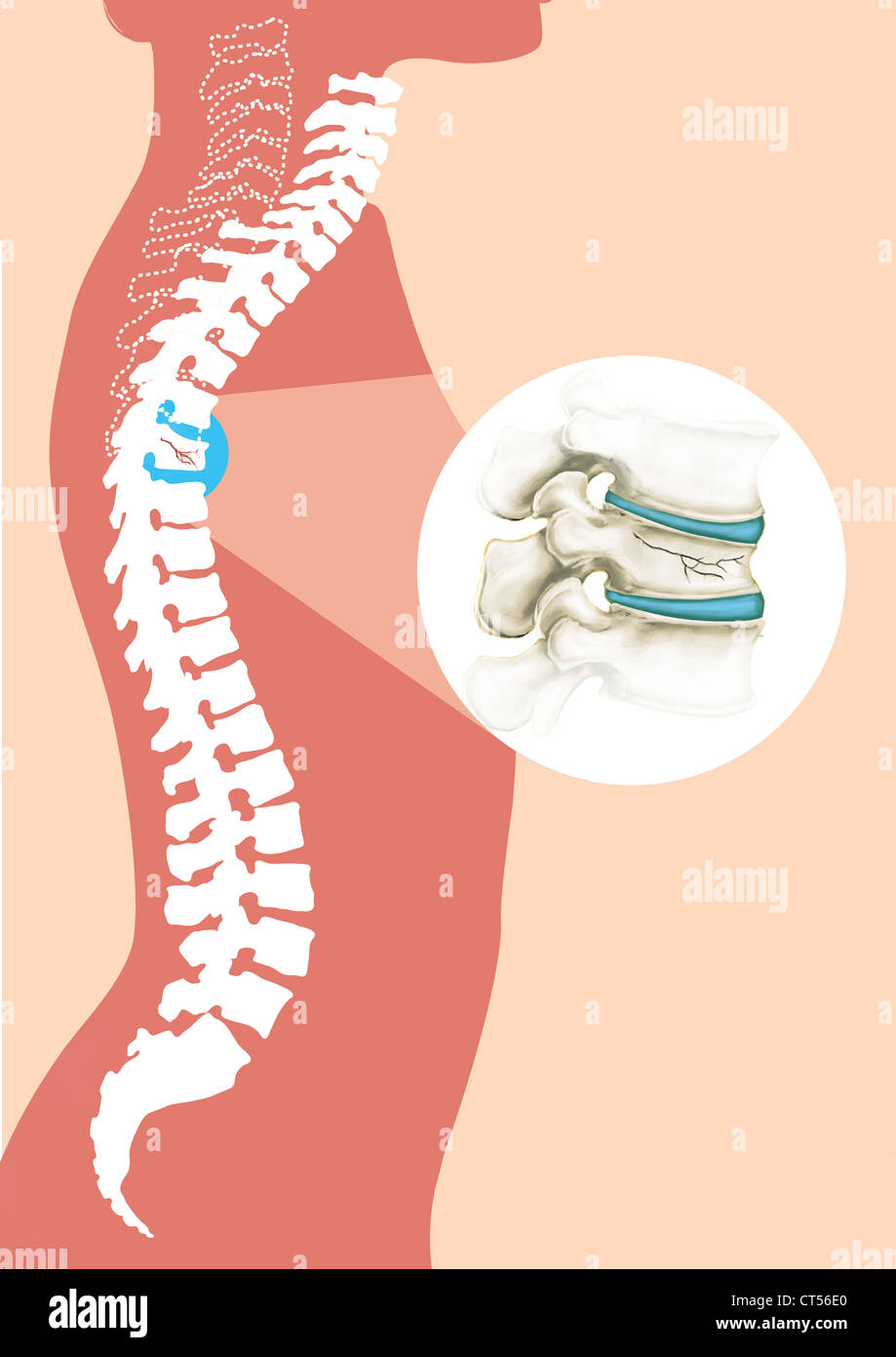FRACTURE par tassement, dessin Photo Stock - Alamy