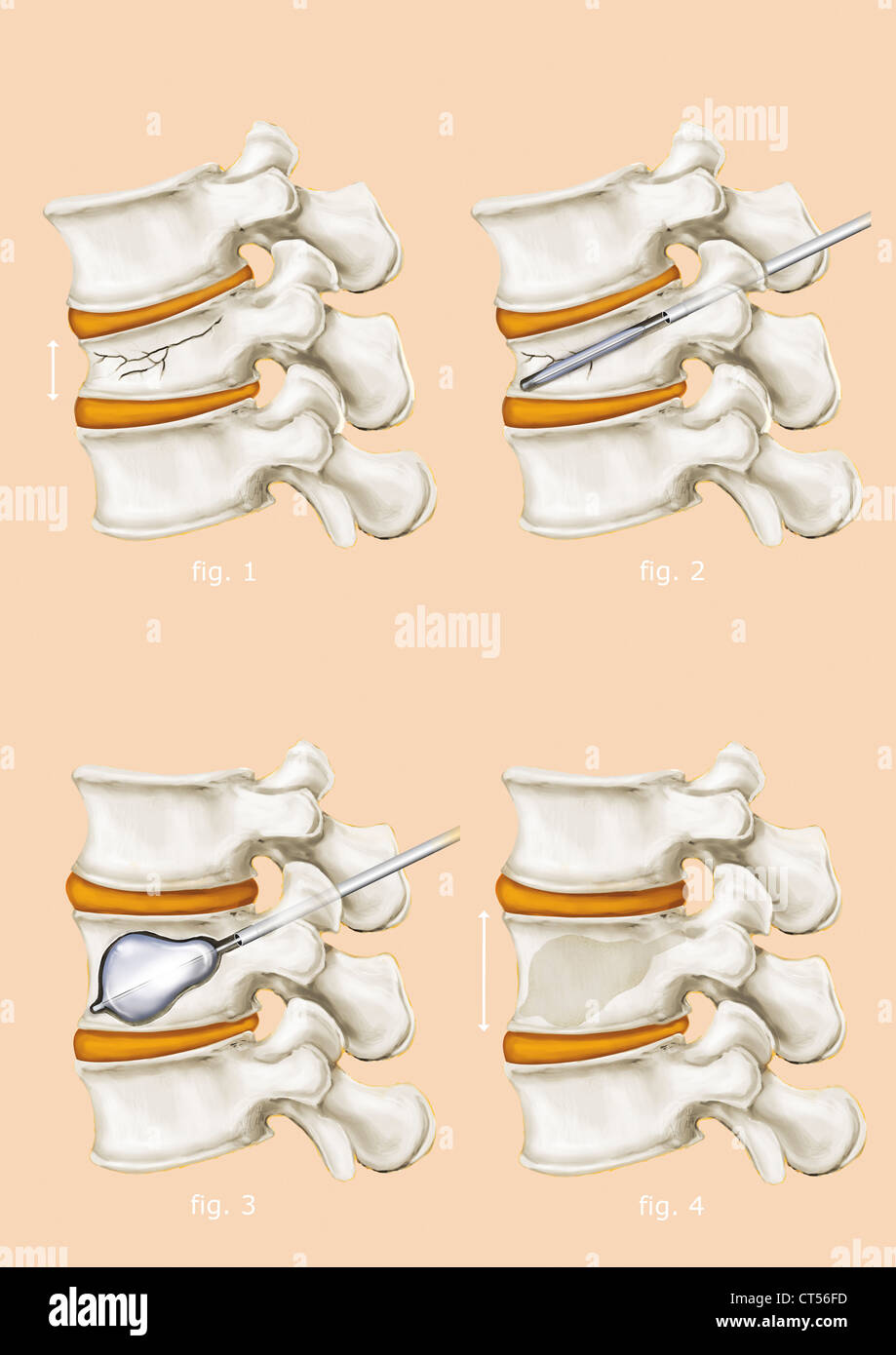Fracture pathologique Banque de photographies et d’images à haute ...