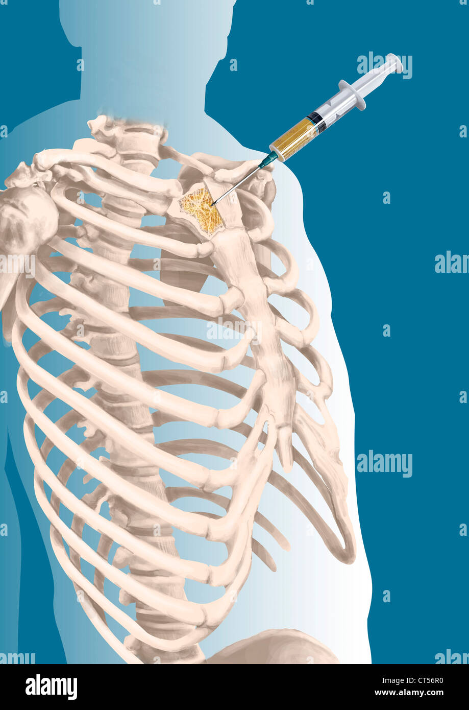 Ponction de moelle osseuse Banque de photographies et d’images à haute ...