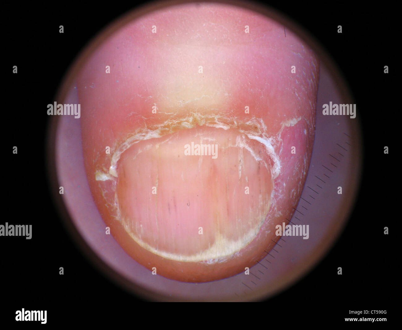 Lichen planus Banque de photographies et d’images à haute résolution ...