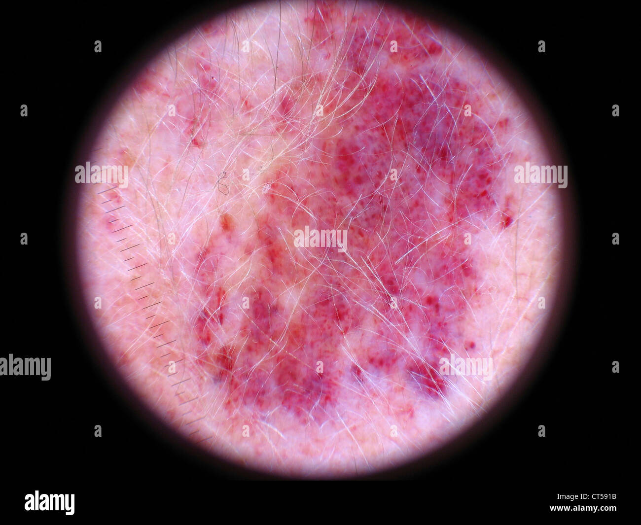 Skin angioma Banque de photographies et d’images à haute résolution - Alamy