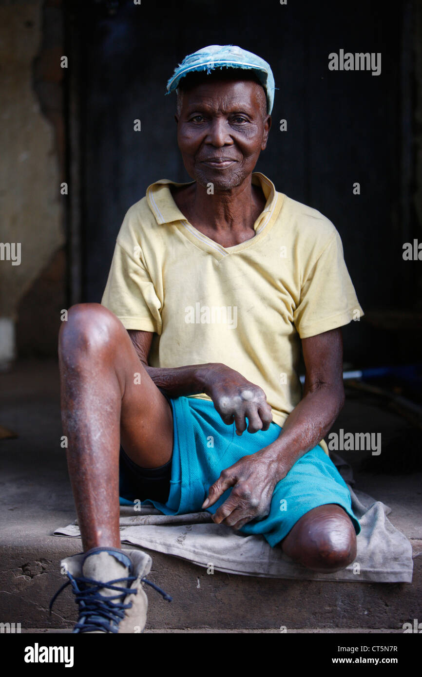La lèpre Banque de photographies et d’images à haute résolution - Alamy