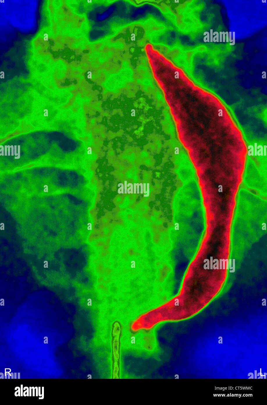 Fibrome utérin Banque de photographies et d’images à haute résolution ...