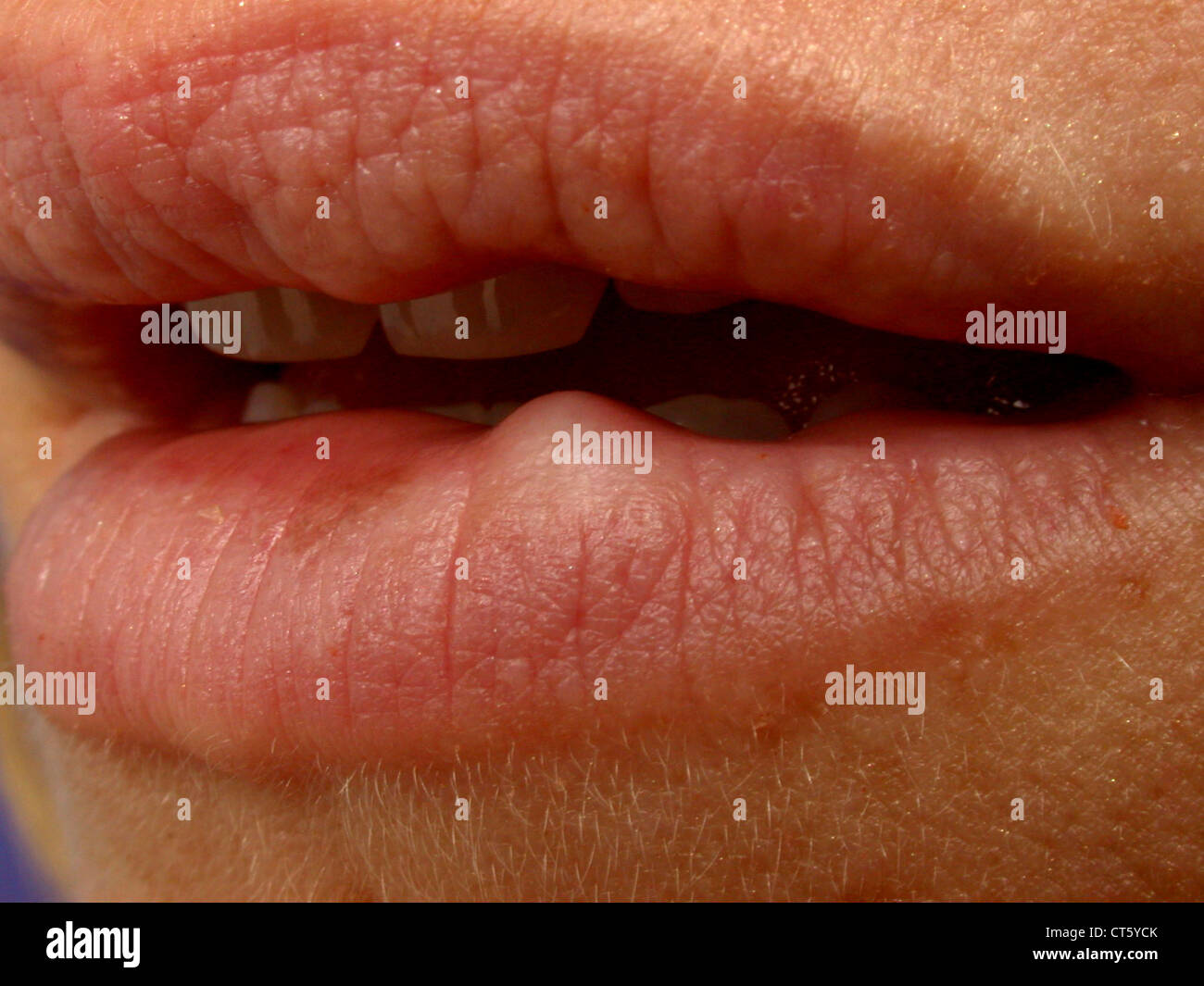 Maladie De La Muqueuse Banque d'image et photos - Alamy