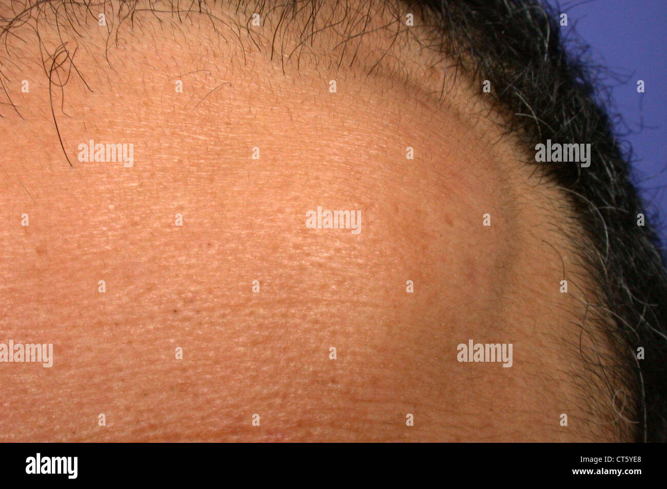 Maladies dermatologiques Banque de photographies et d’images à haute ...