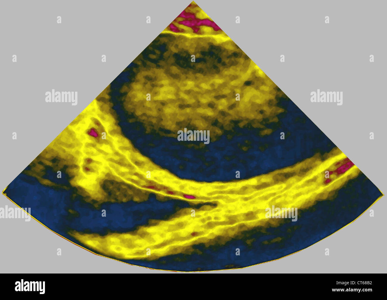 D'épanchement péricardique, l'échographie Photo Stock - Alamy