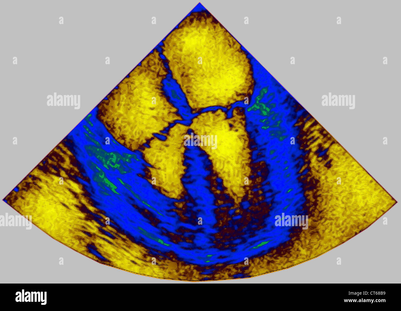 Septa cardiaques Banque de photographies et d’images à haute résolution ...