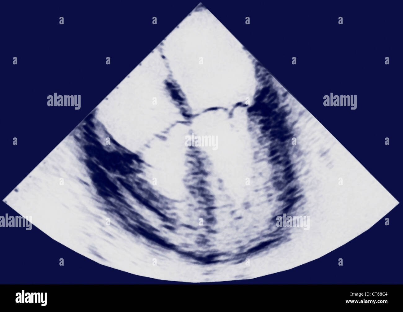 Valves auriculo ventriculaires Banque de photographies et d’images à ...