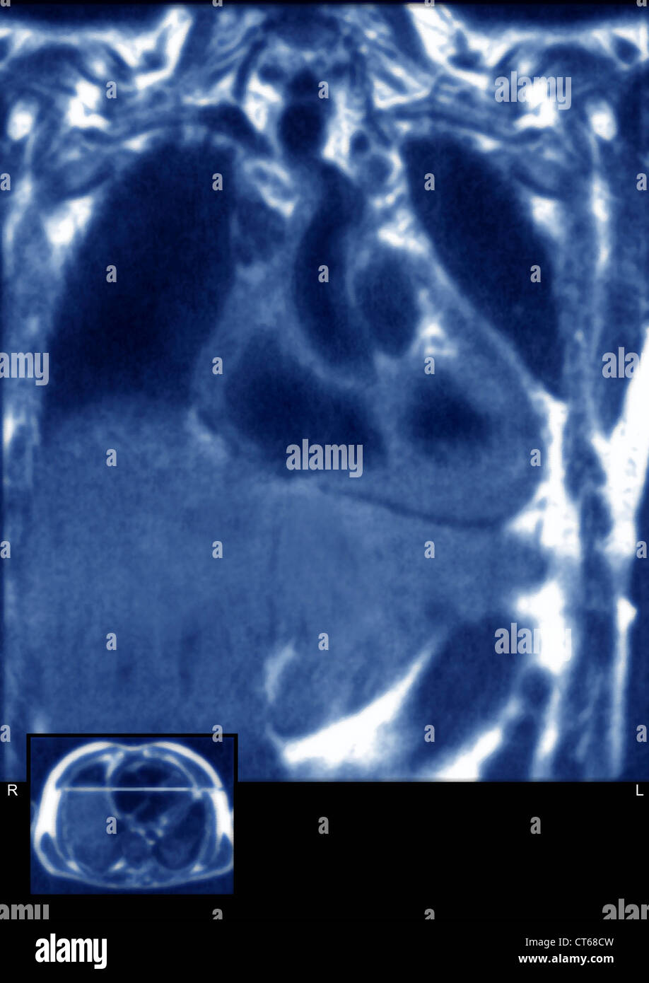 Irm cardiaque Banque de photographies et d’images à haute résolution ...