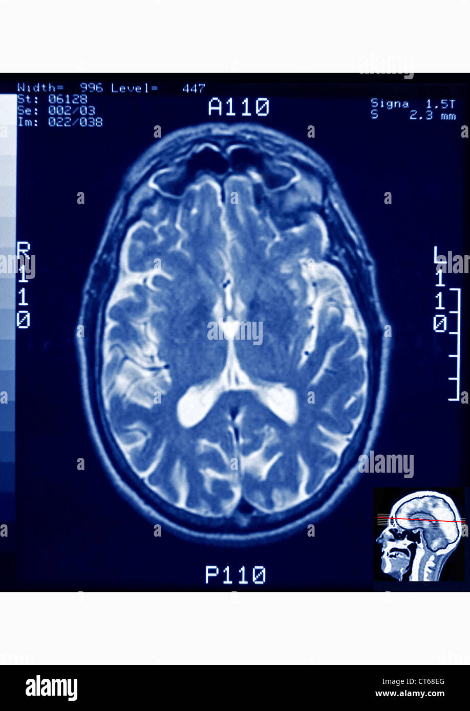 Irm normal du cerveau Banque de photographies et d’images à haute ...