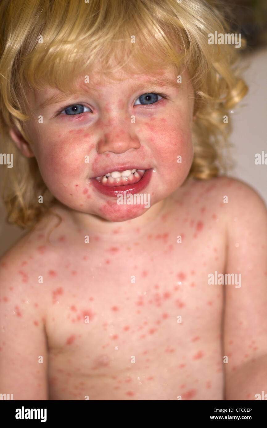 Jolie fille avec la varicelle des taches sur son visage et corps Photo ...