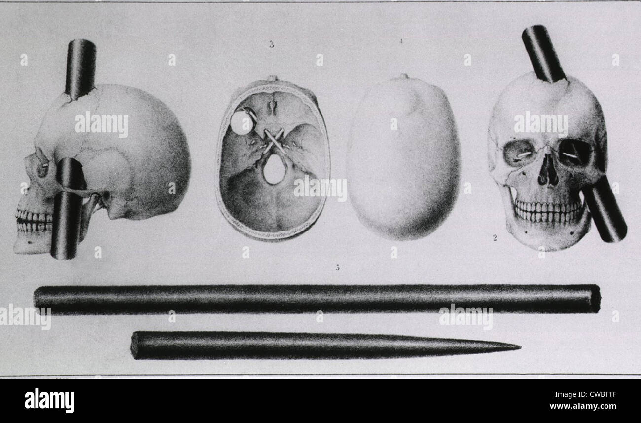 Phineas gage skull Banque de photographies et d’images à haute ...