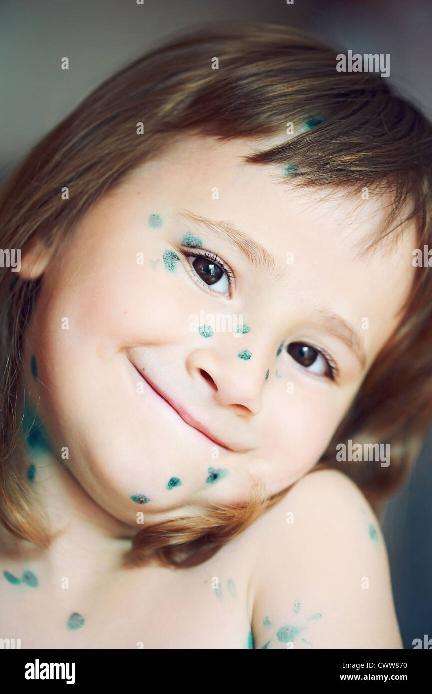 La varicelle Banque de photographies et d’images à haute résolution - Alamy