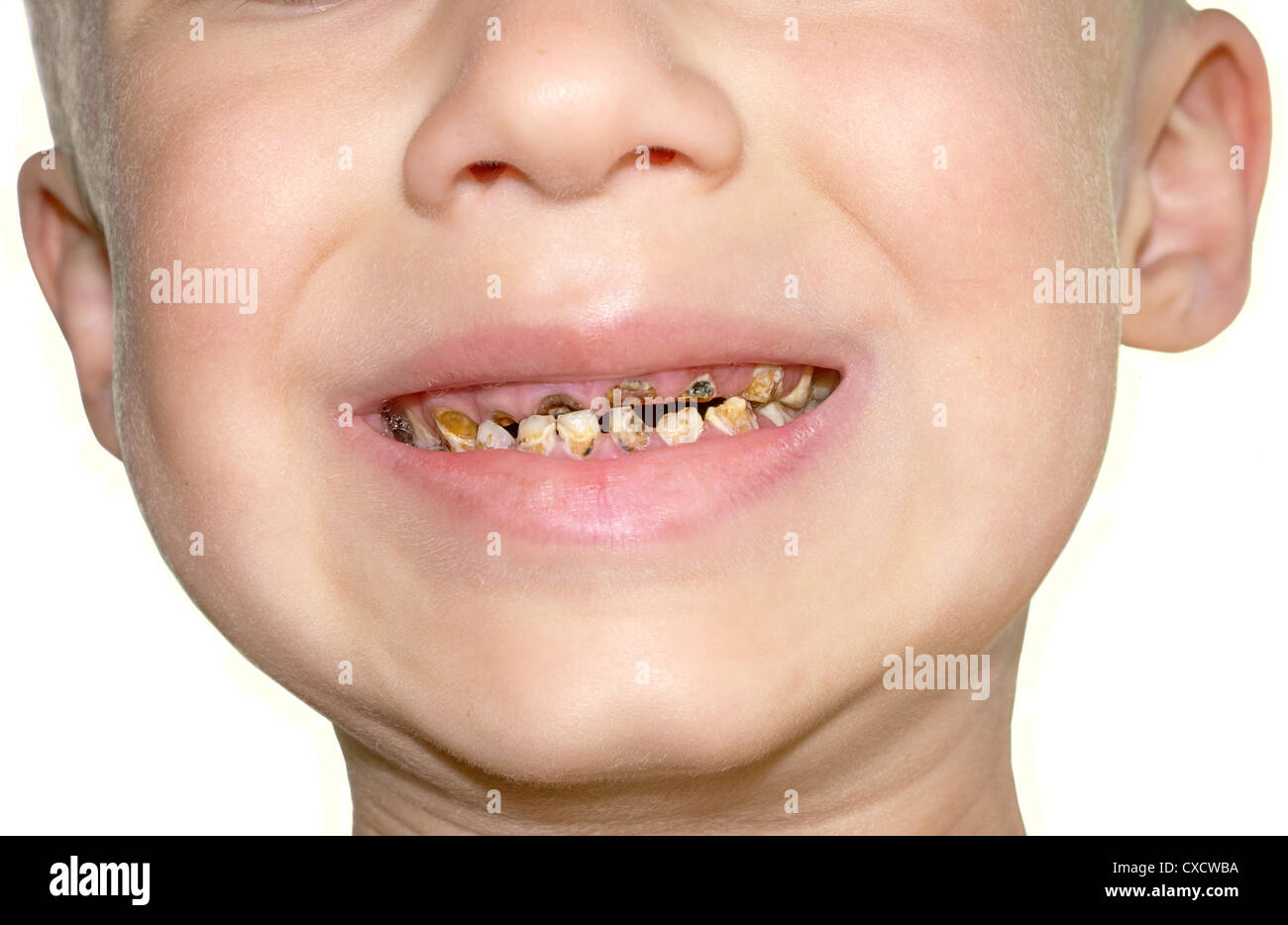 Tooth decay child Banque de photographies et d’images à haute résolution - Alamy