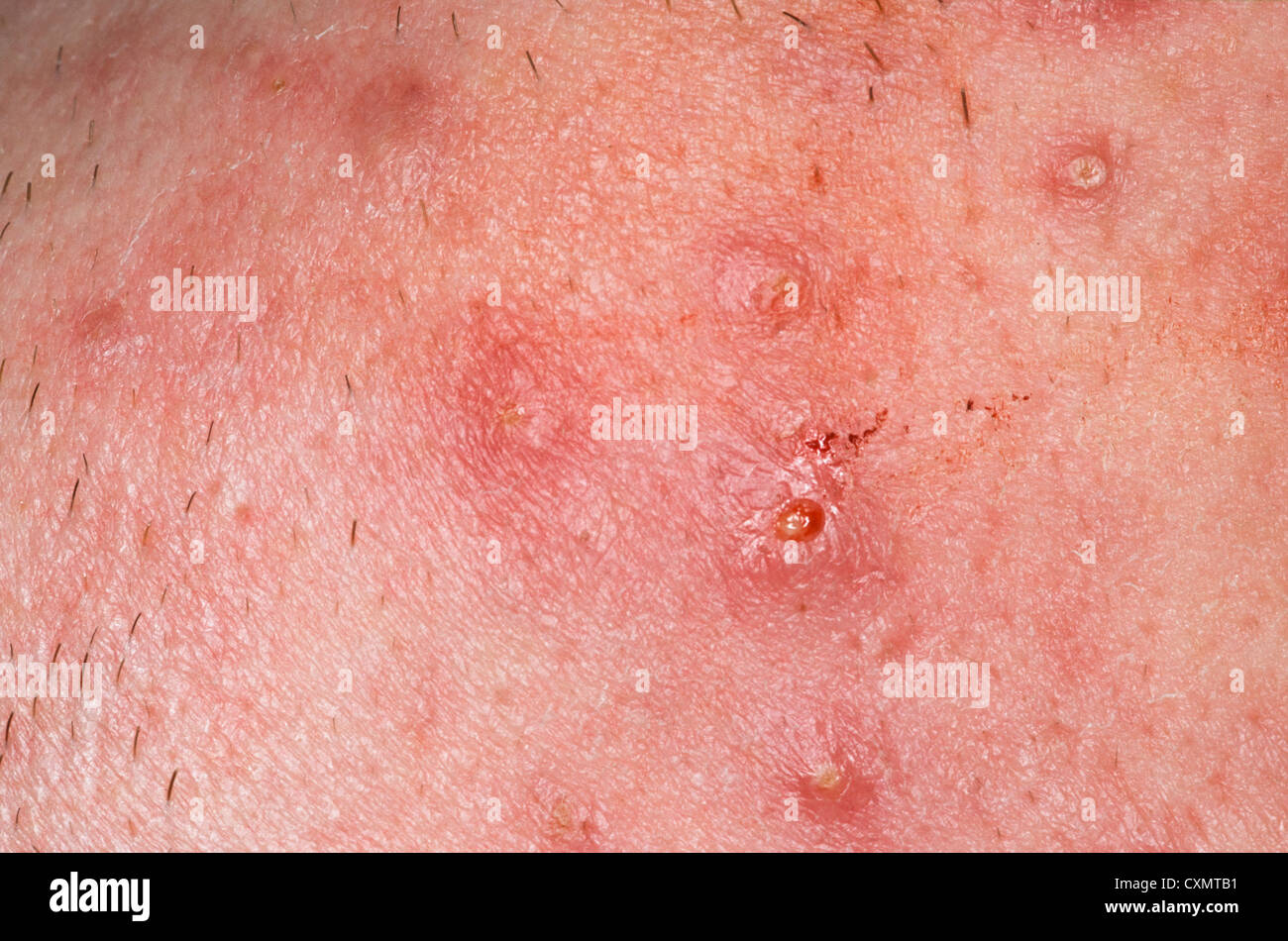Acne rash comedones pustules Banque de photographies et d’images à ...