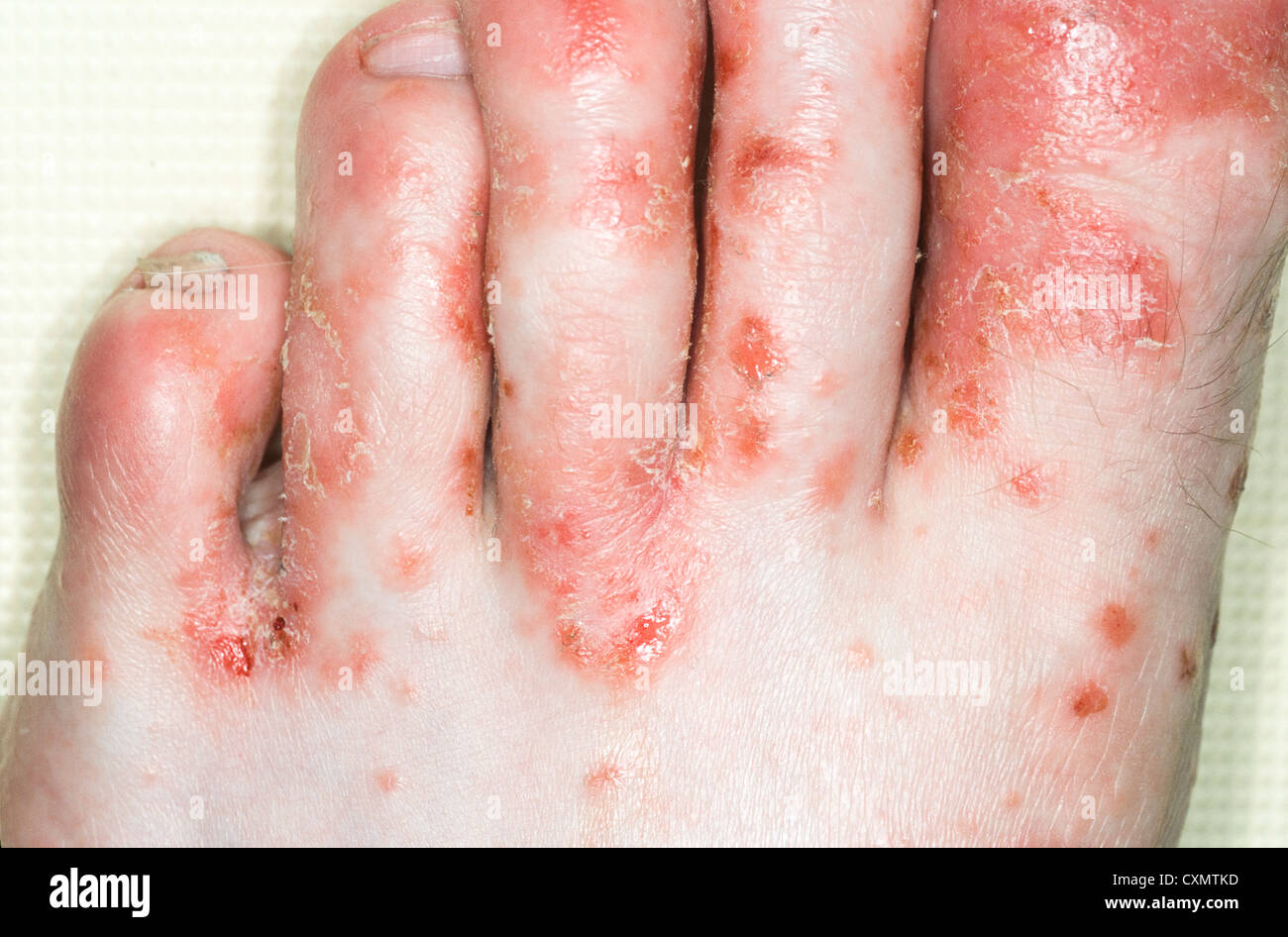 Staphylococcal Infection Banque d'image et photos - Alamy