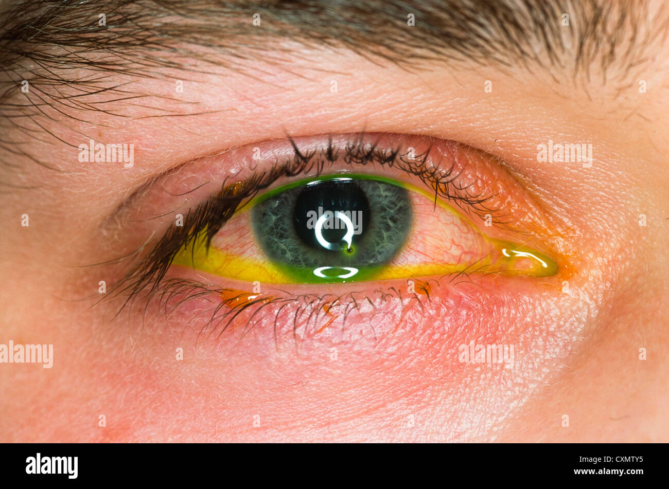 Abrasion de la cornée Banque de photographies et d’images à haute ...