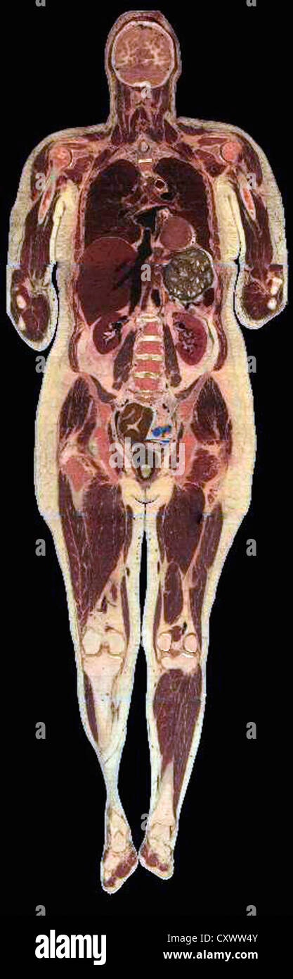 Female cadaver Banque de photographies et d’images à haute résolution ...