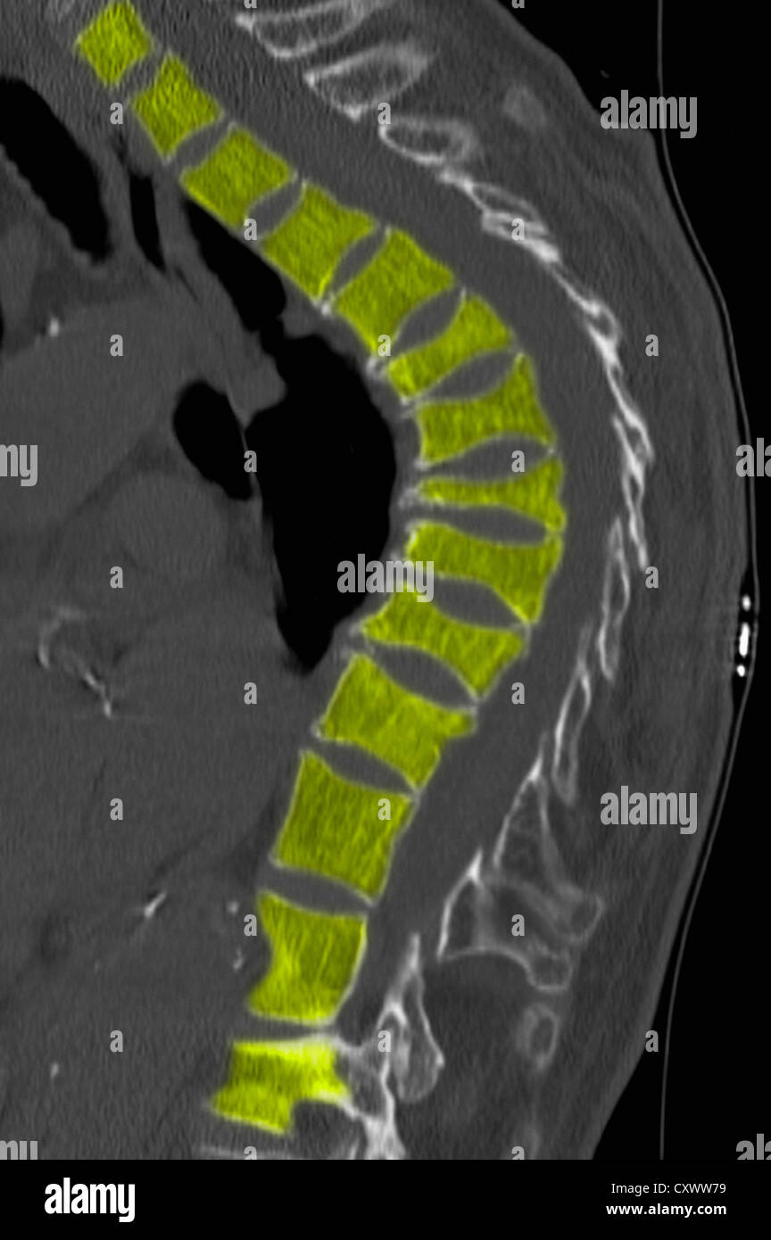 Ct scan thoracic spine osteoporosis Banque de photographies et d’images ...
