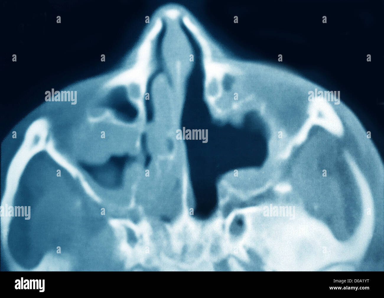 Sinus ethmoïdal Banque de photographies et d’images à haute résolution ...